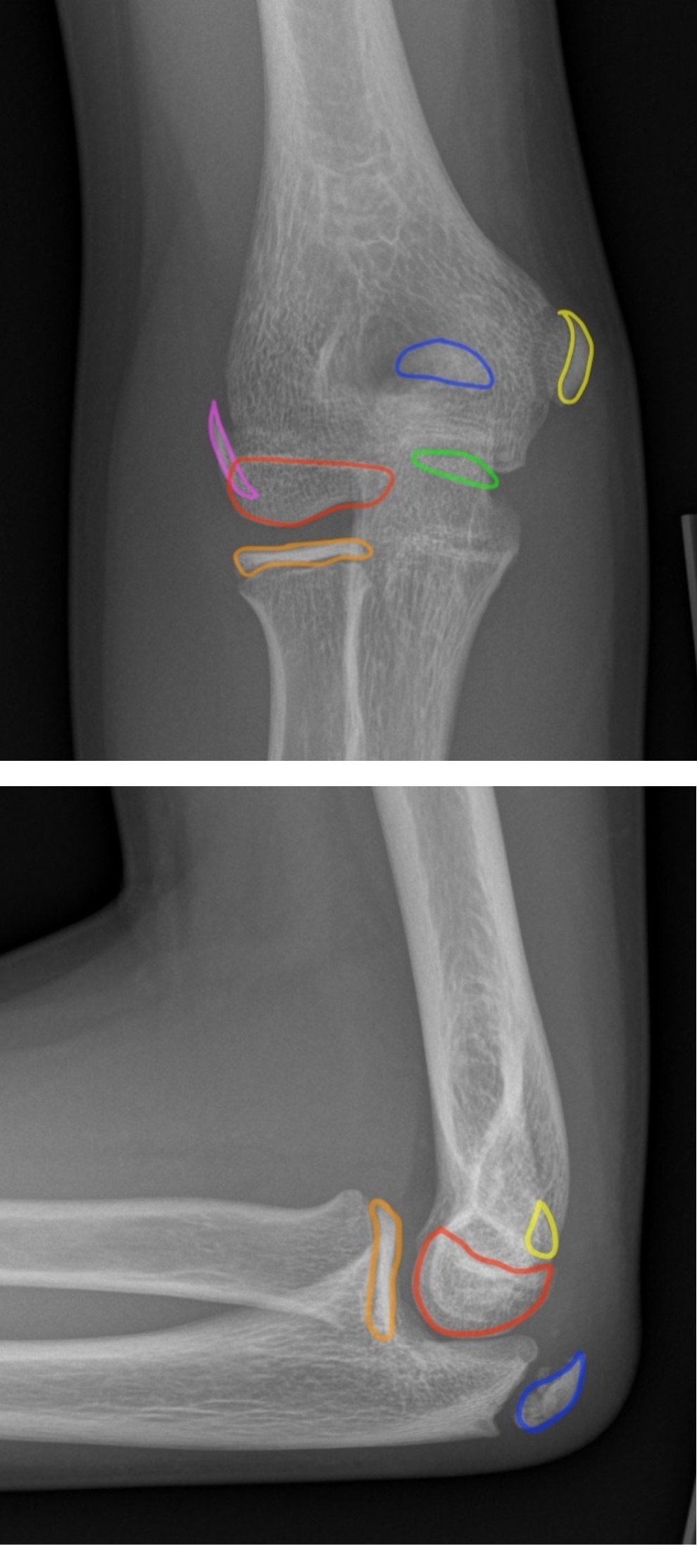 Pediatric Elbow Radiology U Of U School Of Medicine